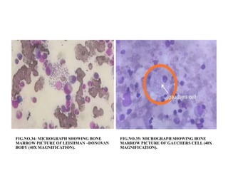BONE MARROW BIOPSY PHOTOGRAPHS.pptx