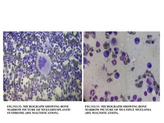 BONE MARROW BIOPSY PHOTOGRAPHS.pptx