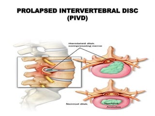 ppt pivd : CARE OF PATIENT HAVING PIVDpptx | PPTX