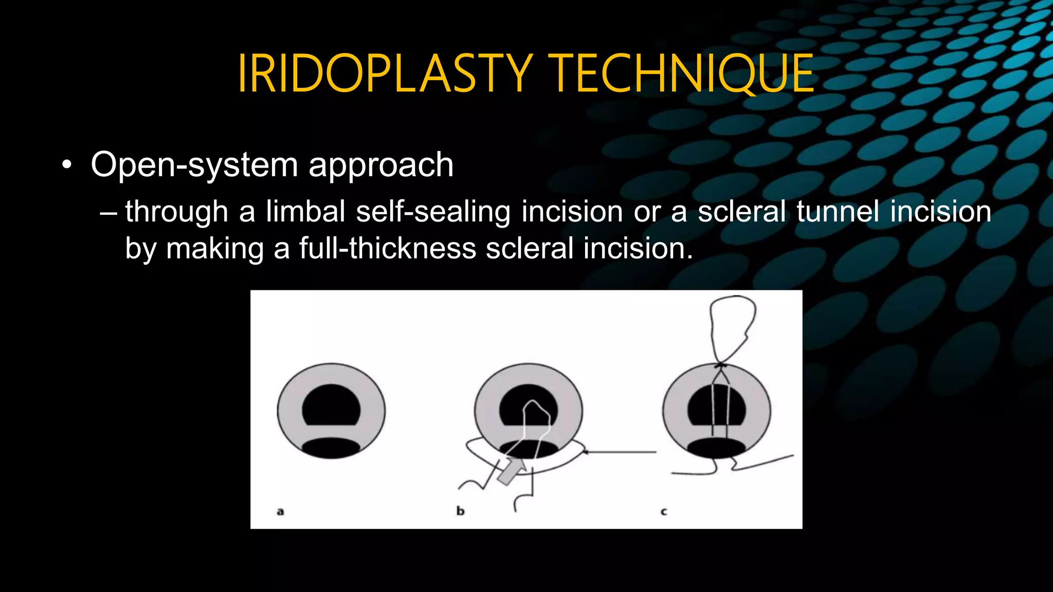 Iridodialysis repair with modified double armed closed chamber ...