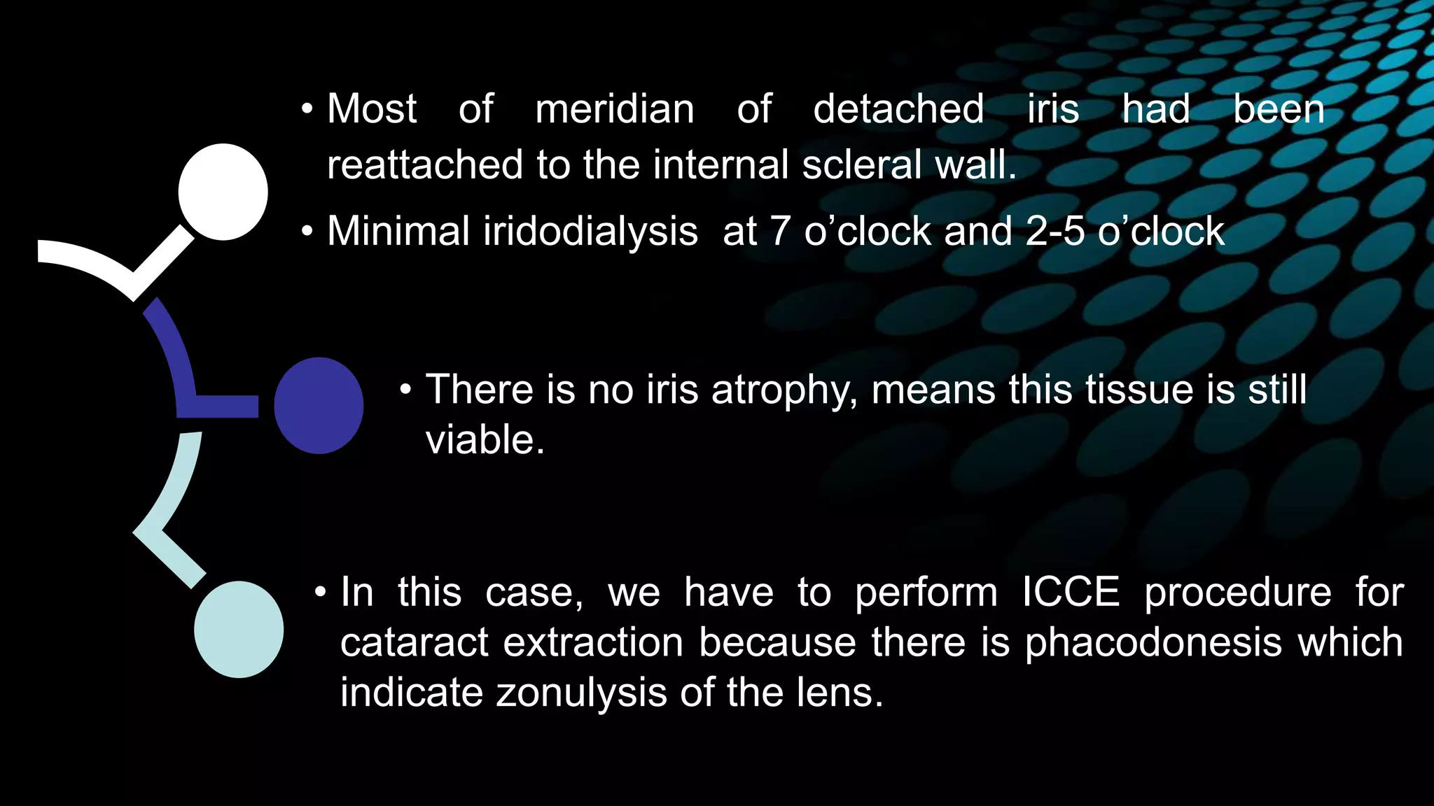 Iridodialysis repair with modified double armed closed chamber ...