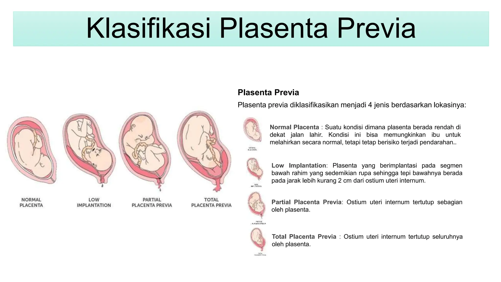 Power point edukasi PLASENTA PREVIA. ppt | PPTX