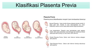 Power point edukasi PLASENTA PREVIA. ppt | PPTX