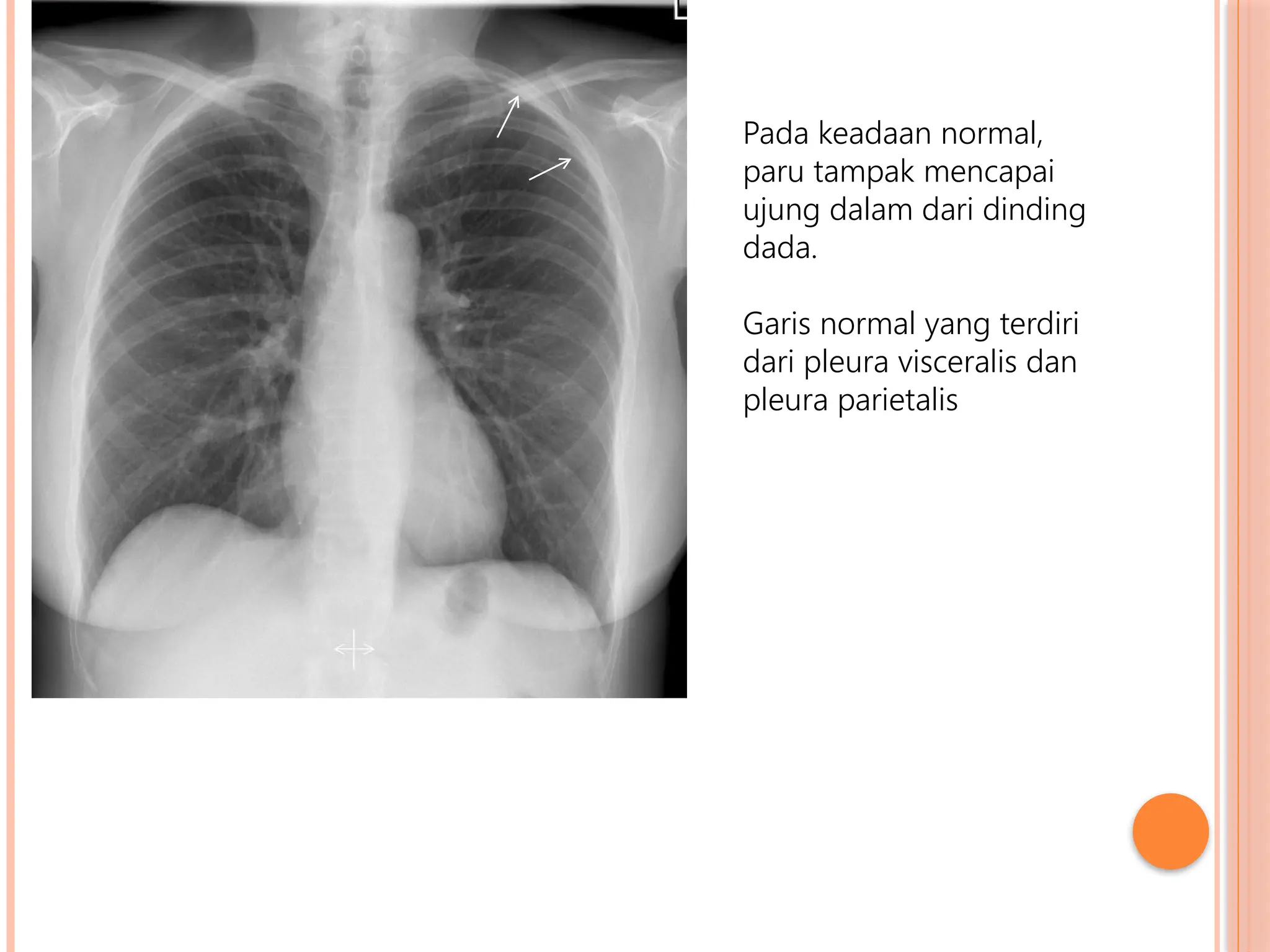 tugas : gambaran radiologis pneumothorax | PPTX