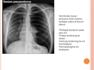 tugas : gambaran radiologis pneumothorax | PPTX