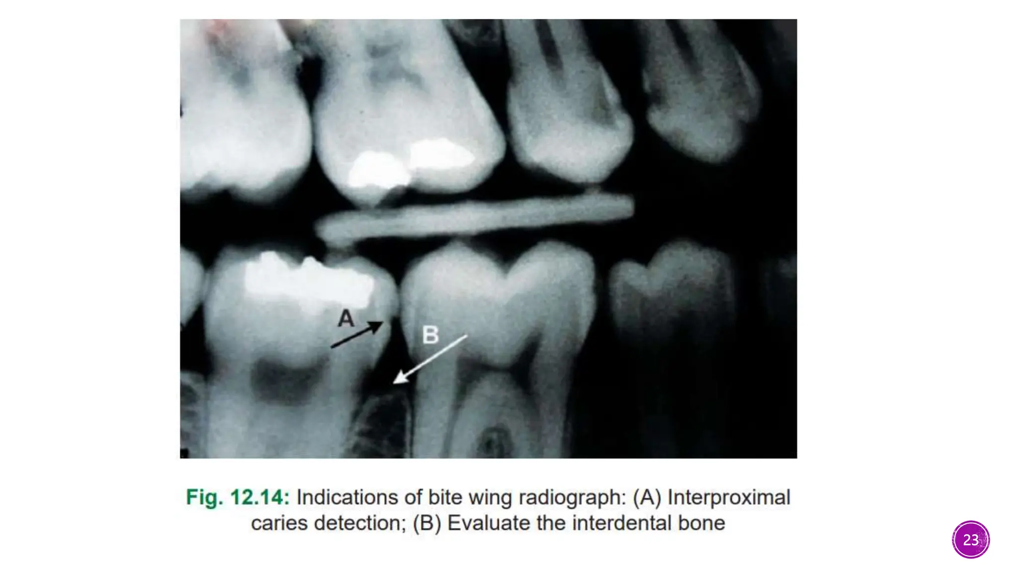 Radiographic Techniques in Pediatric Dentistry- part one , Essentials ...