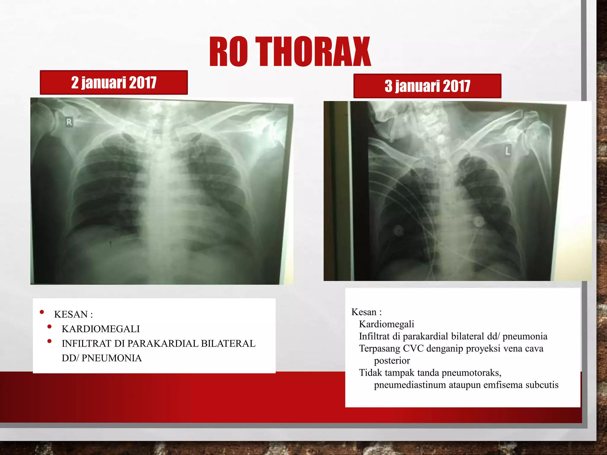 Audit Sepsis : Case Report | PPTX