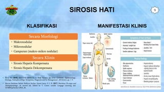 PPT Proposal Sirosis Naldi_giziklinik.pptx