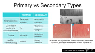 PPT Raynaud Phenomenon ENG 090321.pptx