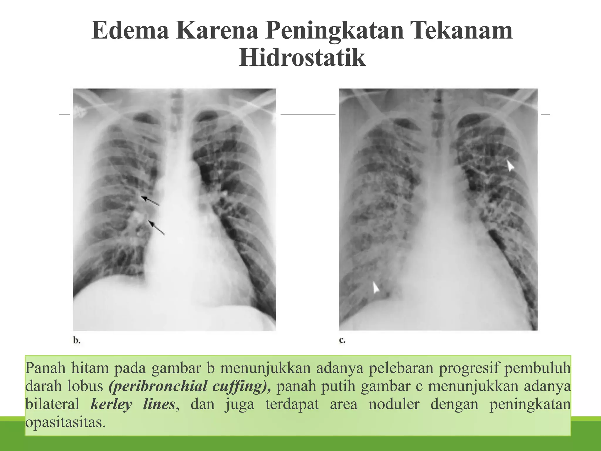 PPT_REFERAT_EDEMA_PARU.ppt