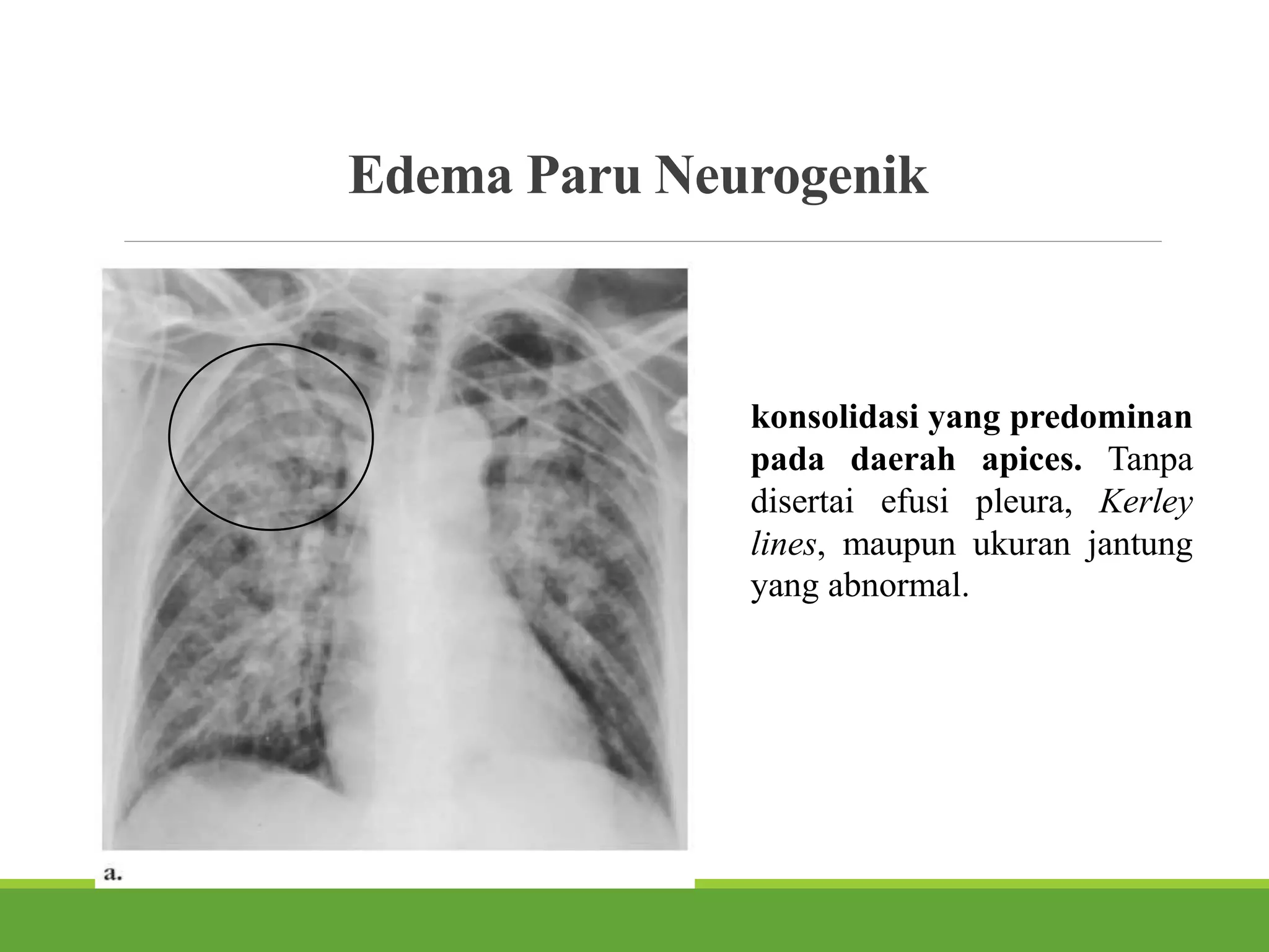 PPT_REFERAT_EDEMA_PARU.ppt