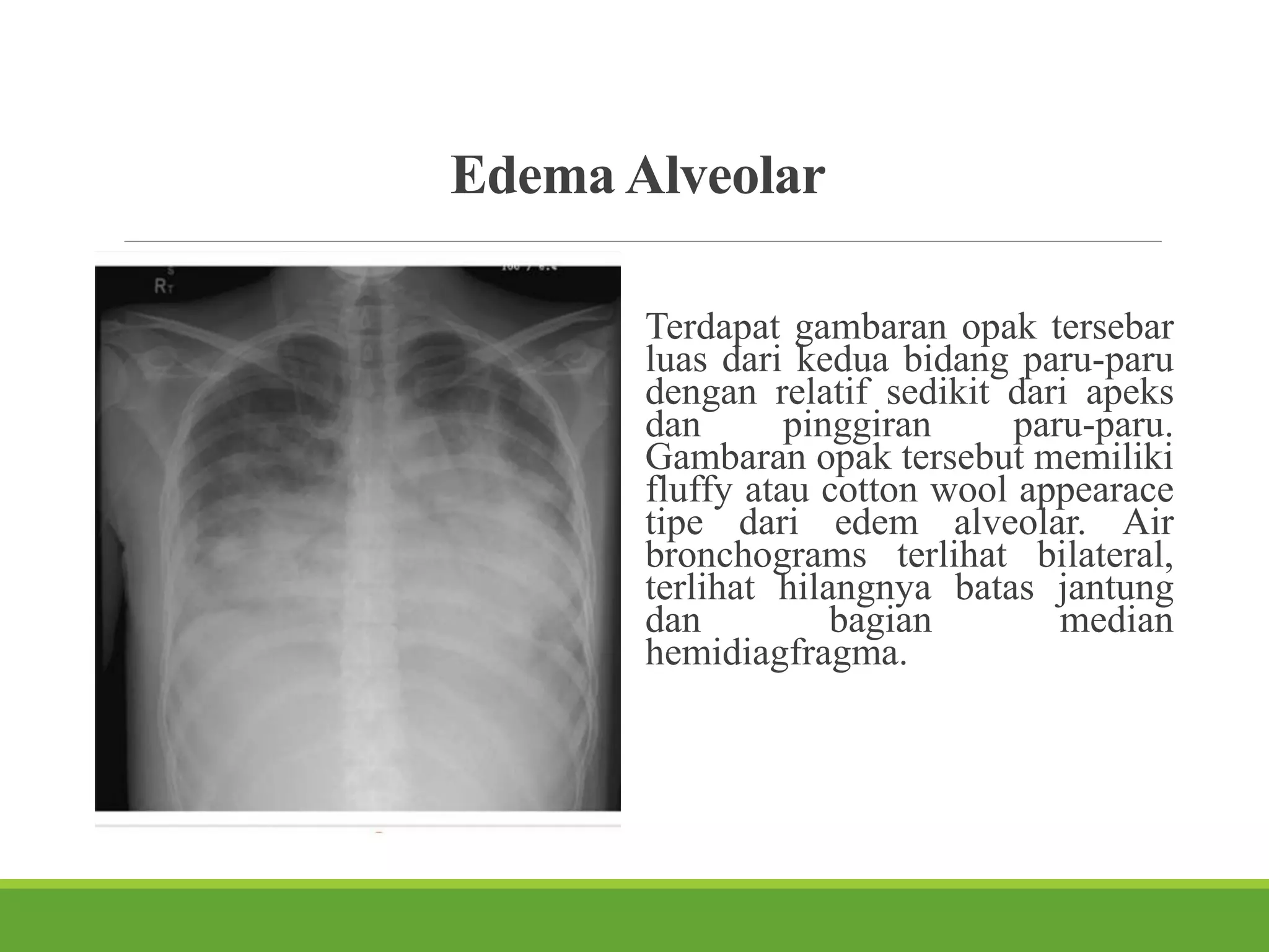 PPT_REFERAT_EDEMA_PARU.ppt