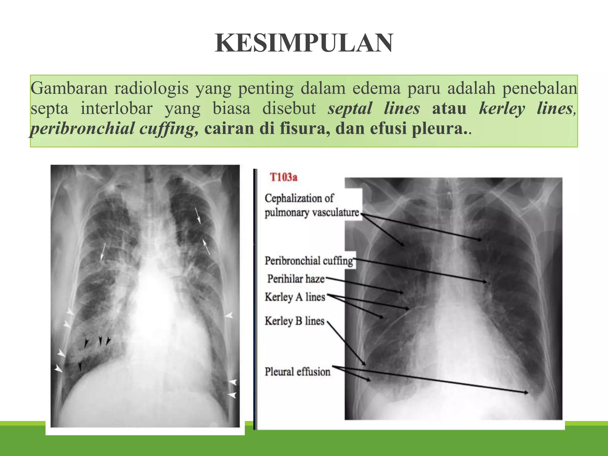 PPT_REFERAT_EDEMA_PARU.ppt