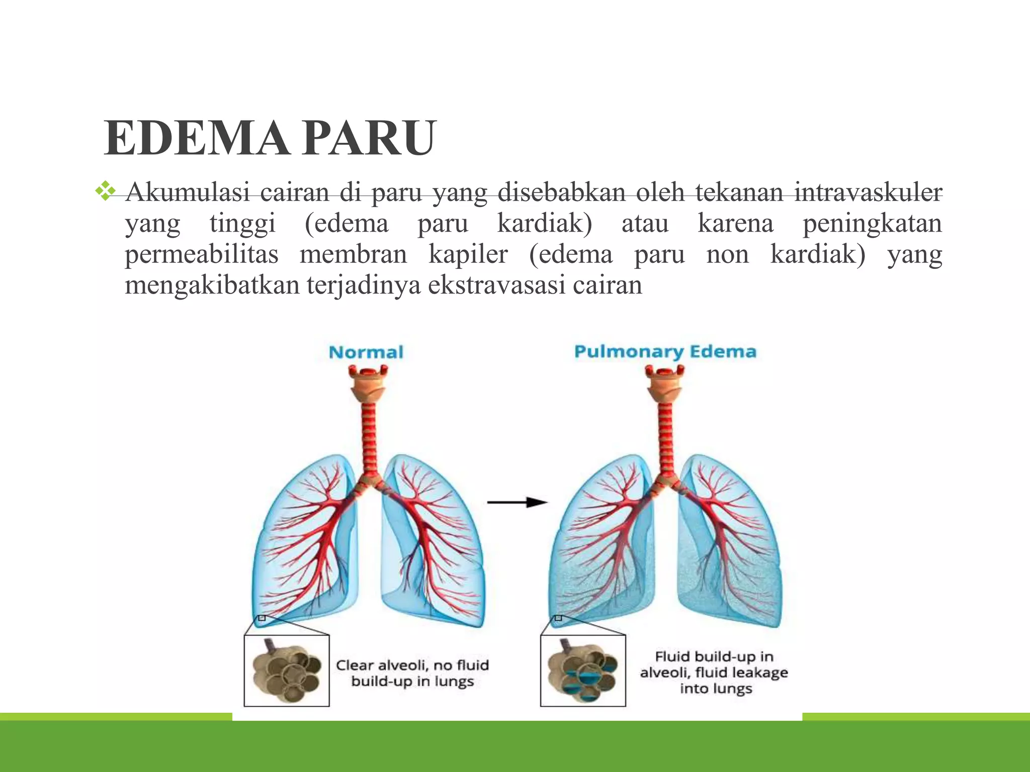 PPT_REFERAT_EDEMA_PARU.ppt