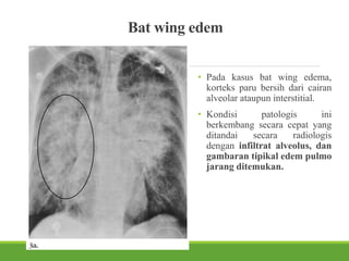 PPT_REFERAT_EDEMA_PARU.ppt