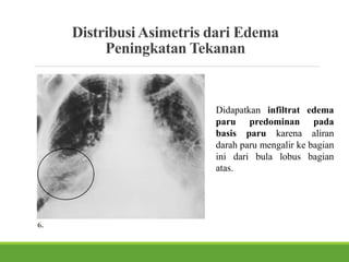 PPT_REFERAT_EDEMA_PARU.ppt