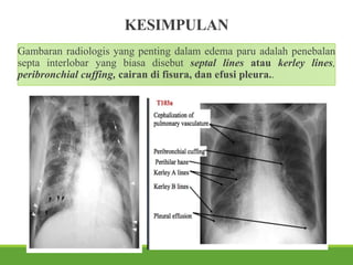PPT_REFERAT_EDEMA_PARU.ppt