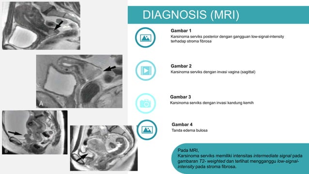 PPT REFERAT RADIOLOGI_KARSINOMA SERVIKS_V11.pptx
