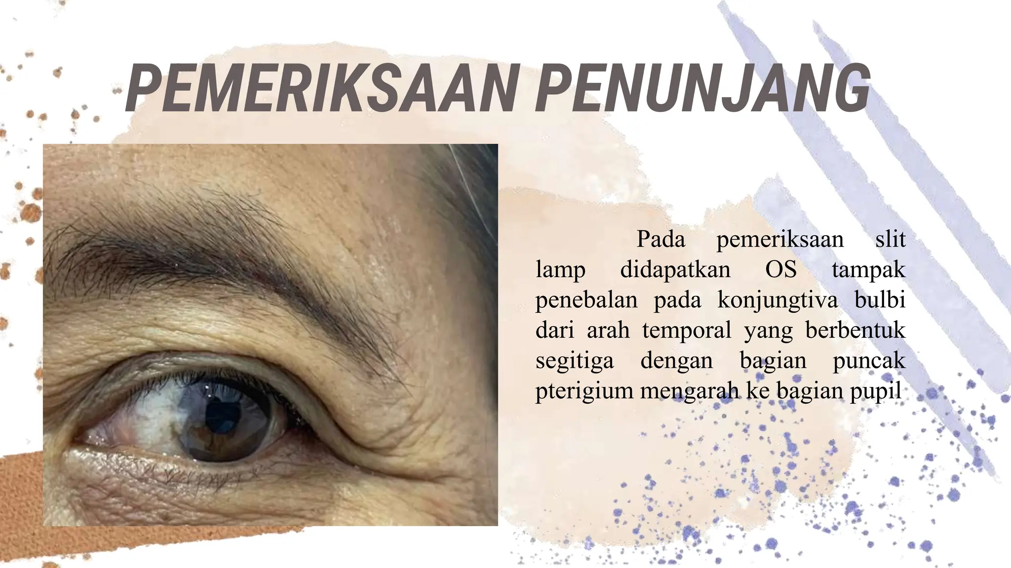 refleksi pterigium mata kedokteran Undata | PPTX