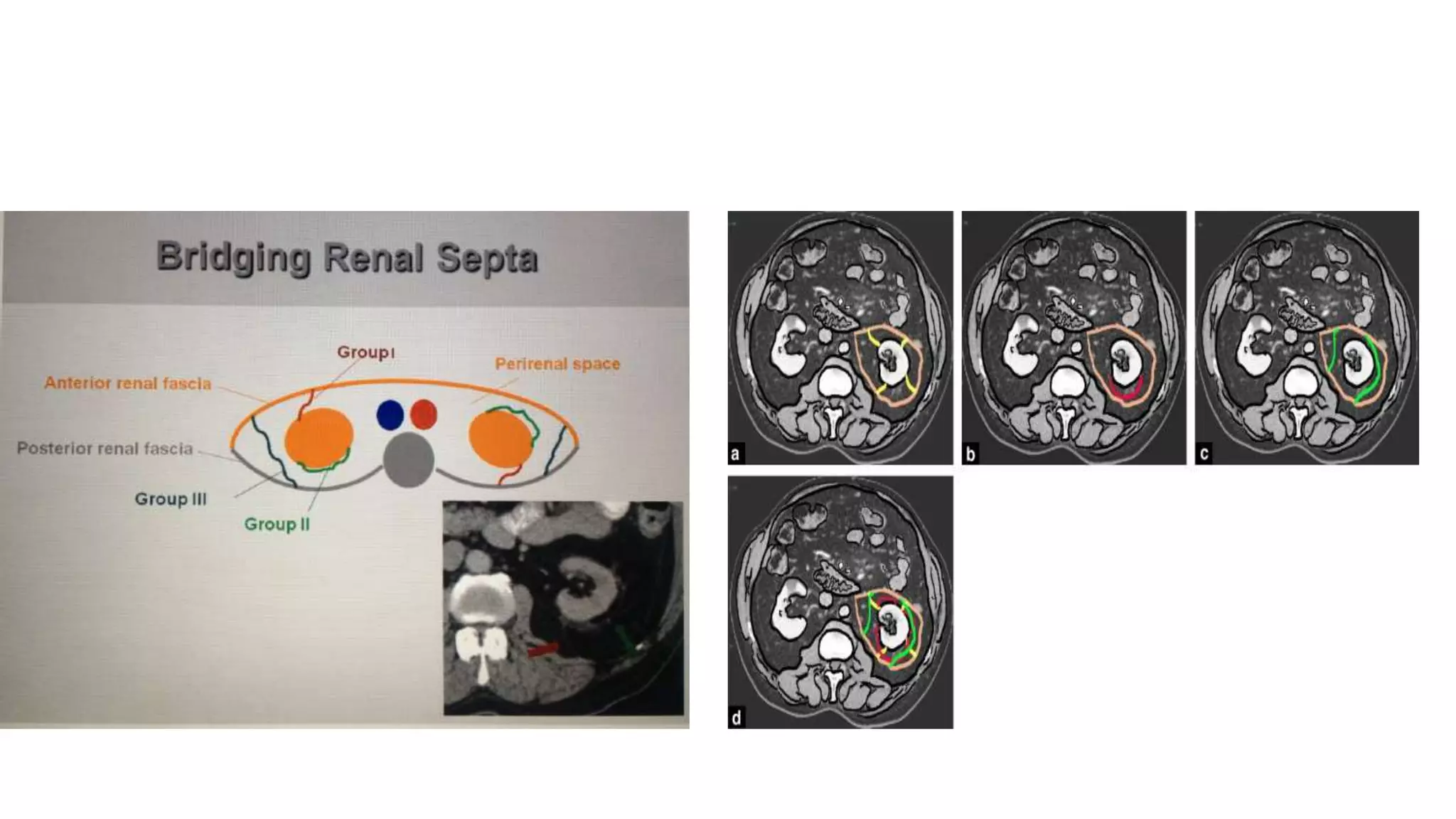 radiological anatomy of retroperitoneum powerpoint | PPTX