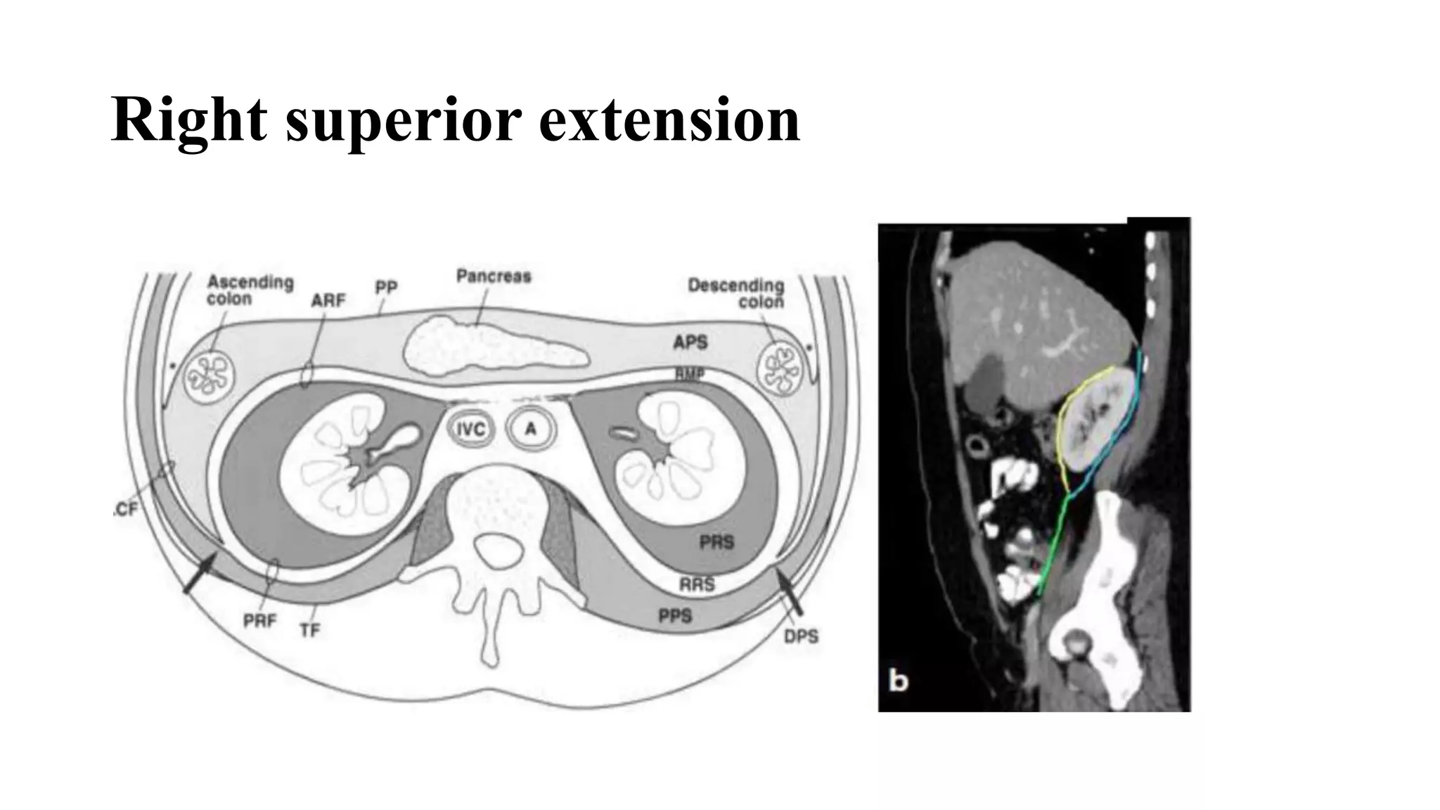 radiological anatomy of retroperitoneum powerpoint | PPTX