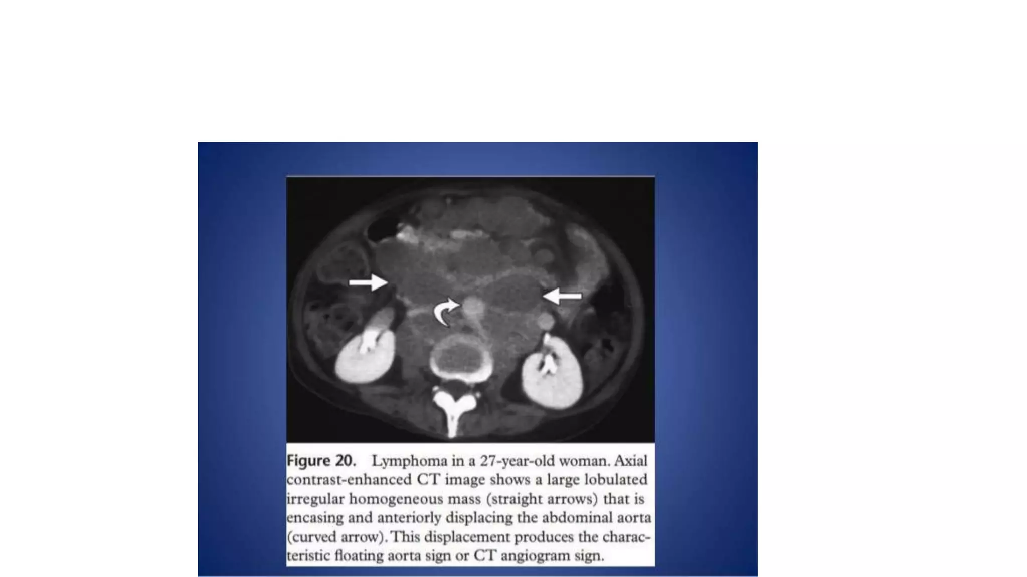 radiological anatomy of retroperitoneum powerpoint | PPTX