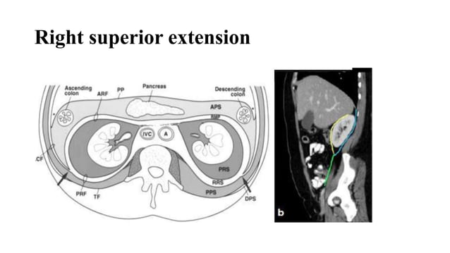radiological anatomy of retroperitoneum powerpoint | PPTX
