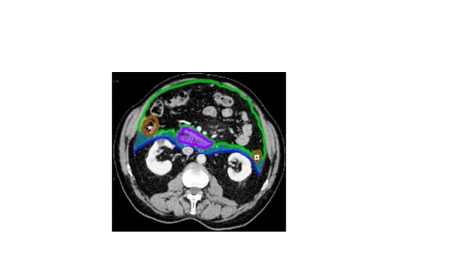 radiological anatomy of retroperitoneum powerpoint | PPTX