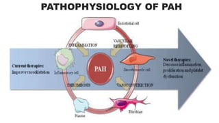 PPT REVIEW ARTICLE PAH.pptx | Lung and Respiratory Health | Diseases ...
