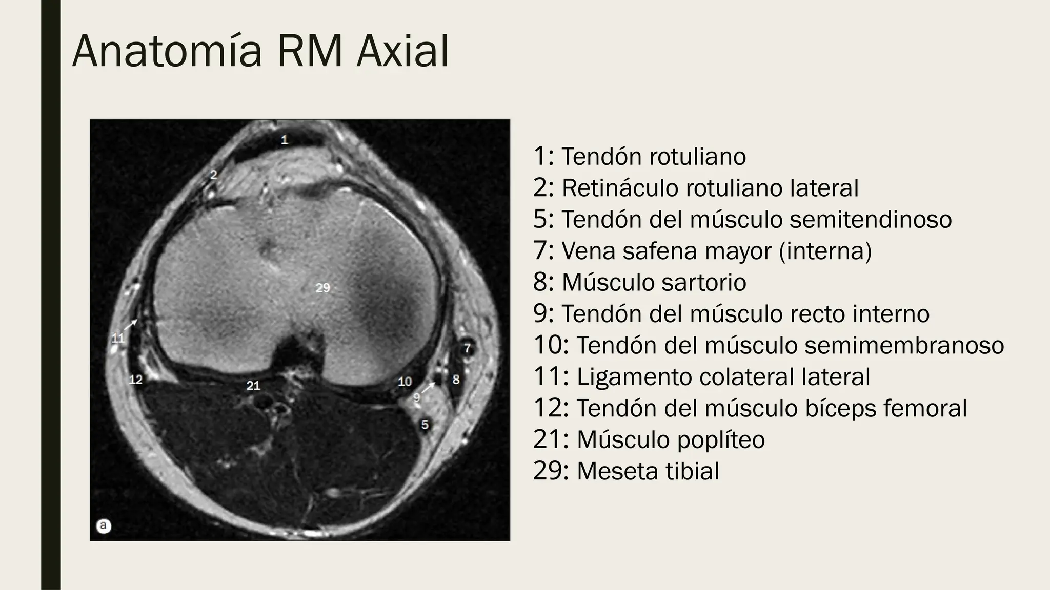 Resonancia Magnética de Rodilla Posicionamiento | PPTX