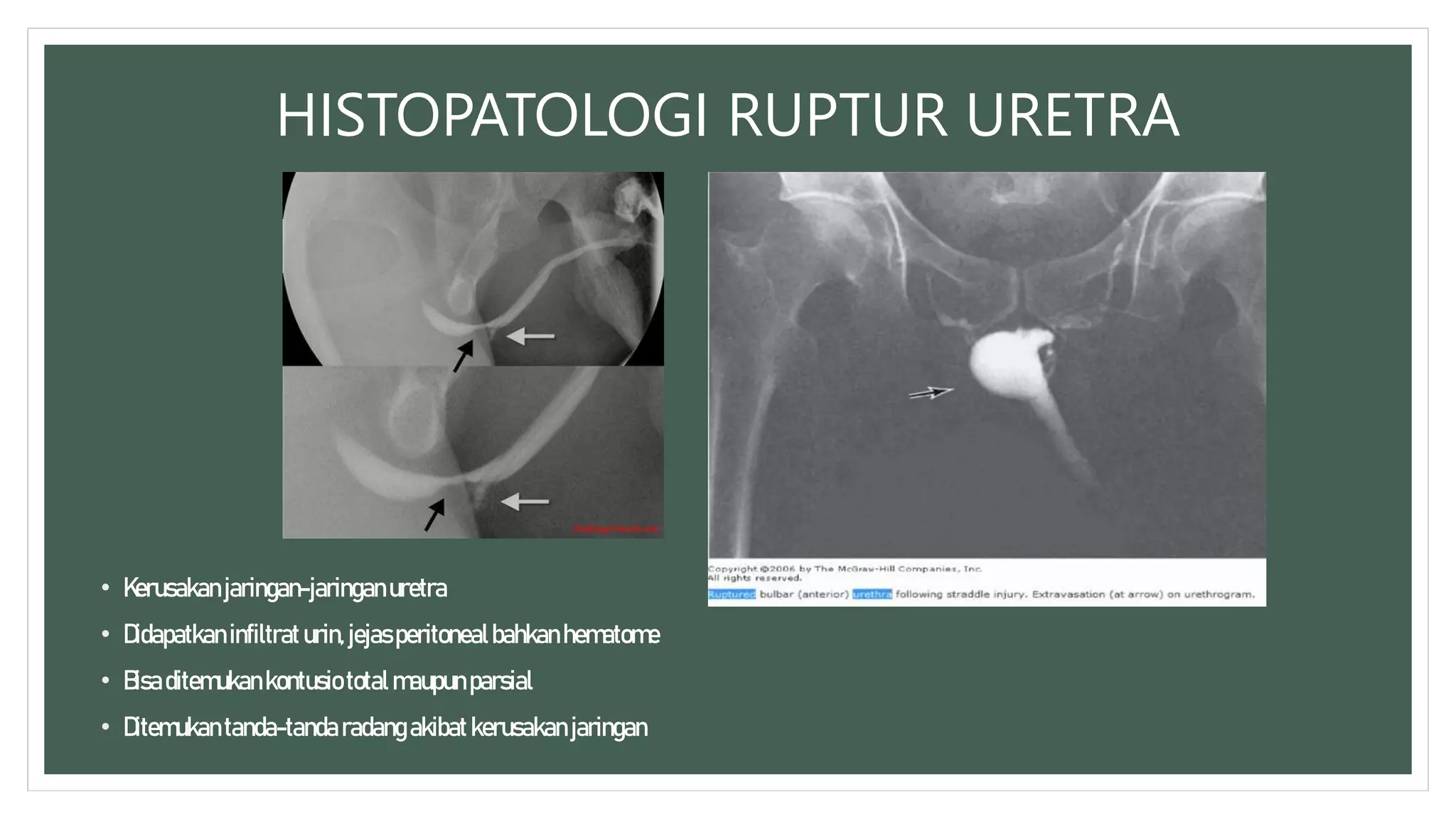 ppt ruptur uretra.pptx