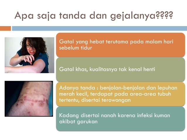 PPT SCABIES penularan pengobatan gejala dan pengobatan | PDF