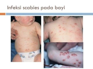 PPT SCABIES penularan pengobatan gejala dan pengobatan | PDF