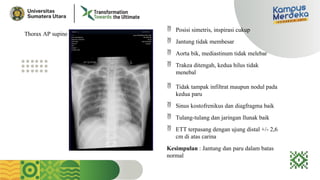 PPT SEMINAR KASUS EPIDURAL HEMATOMA.pptx