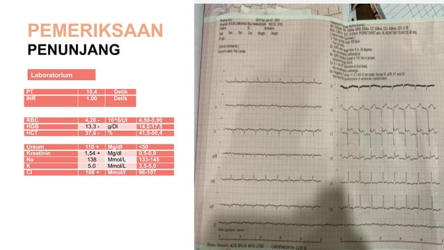 STEMI (ST-elevation myocardial infarction) | PPT