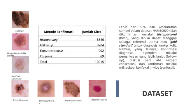 KLASIFIKASI KANKER KULIT PADA CITRA DIGITAL MENGGUNAKAN ALGORITMA ...
