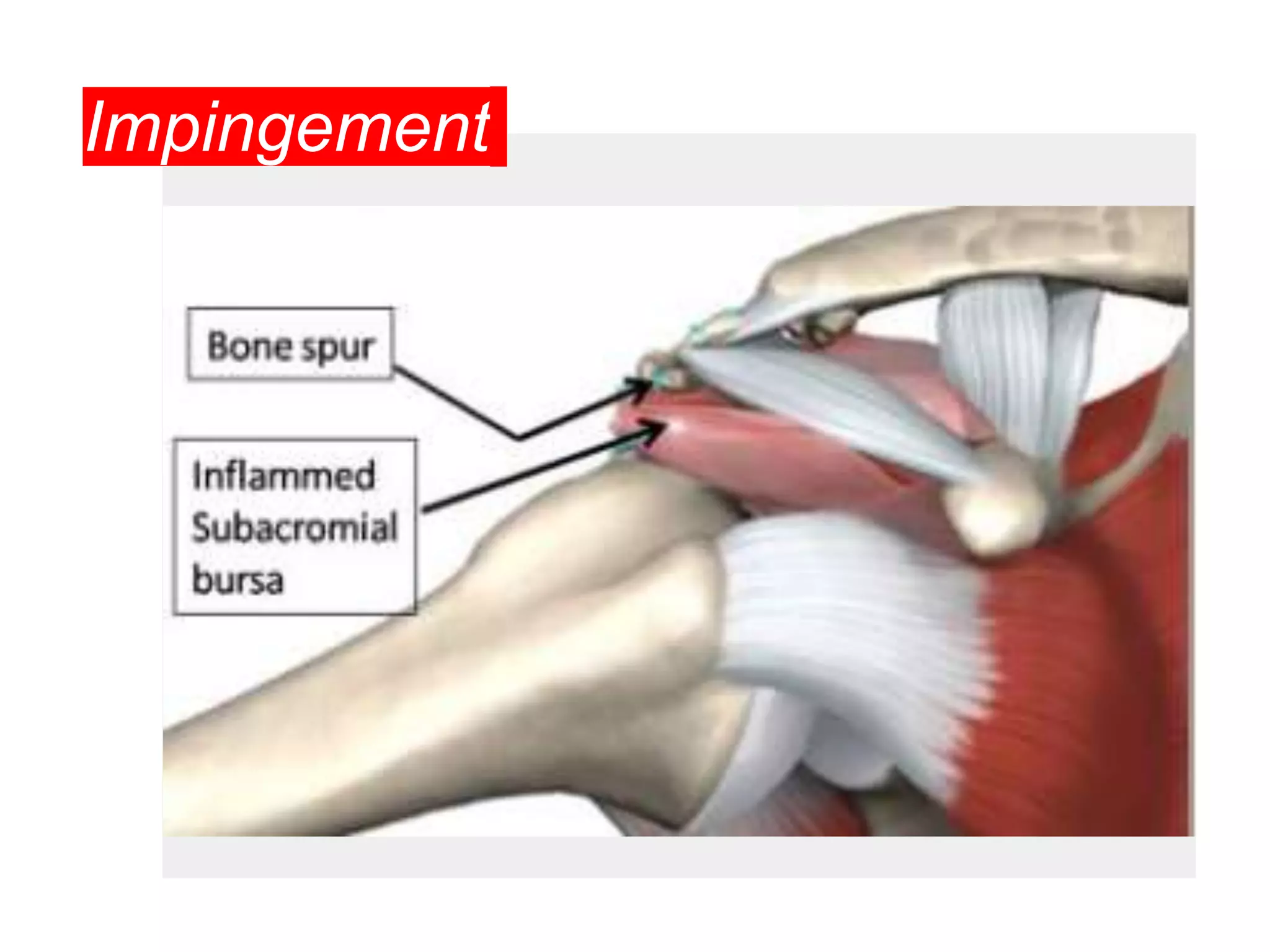 Ppt shoulder pain | PPTX