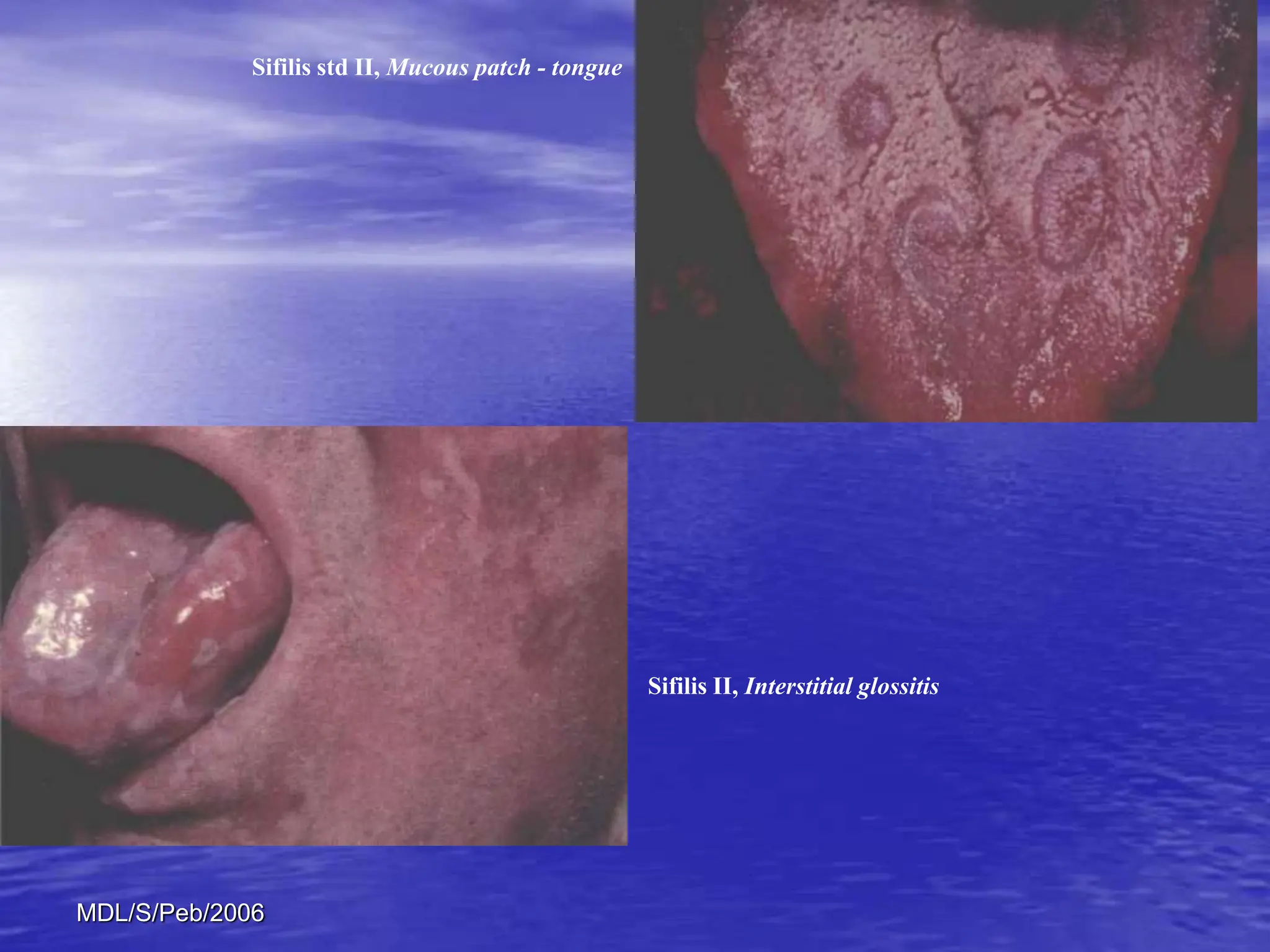 PPT_sifilis (1).ppt untuk masyarakat guna mencegah penyebarannya | PPT