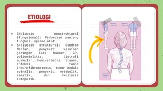 PPT SKOLIOSIS.ppt