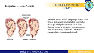 Power Point Solusio Plasenta S1 Keperawatan.pptx