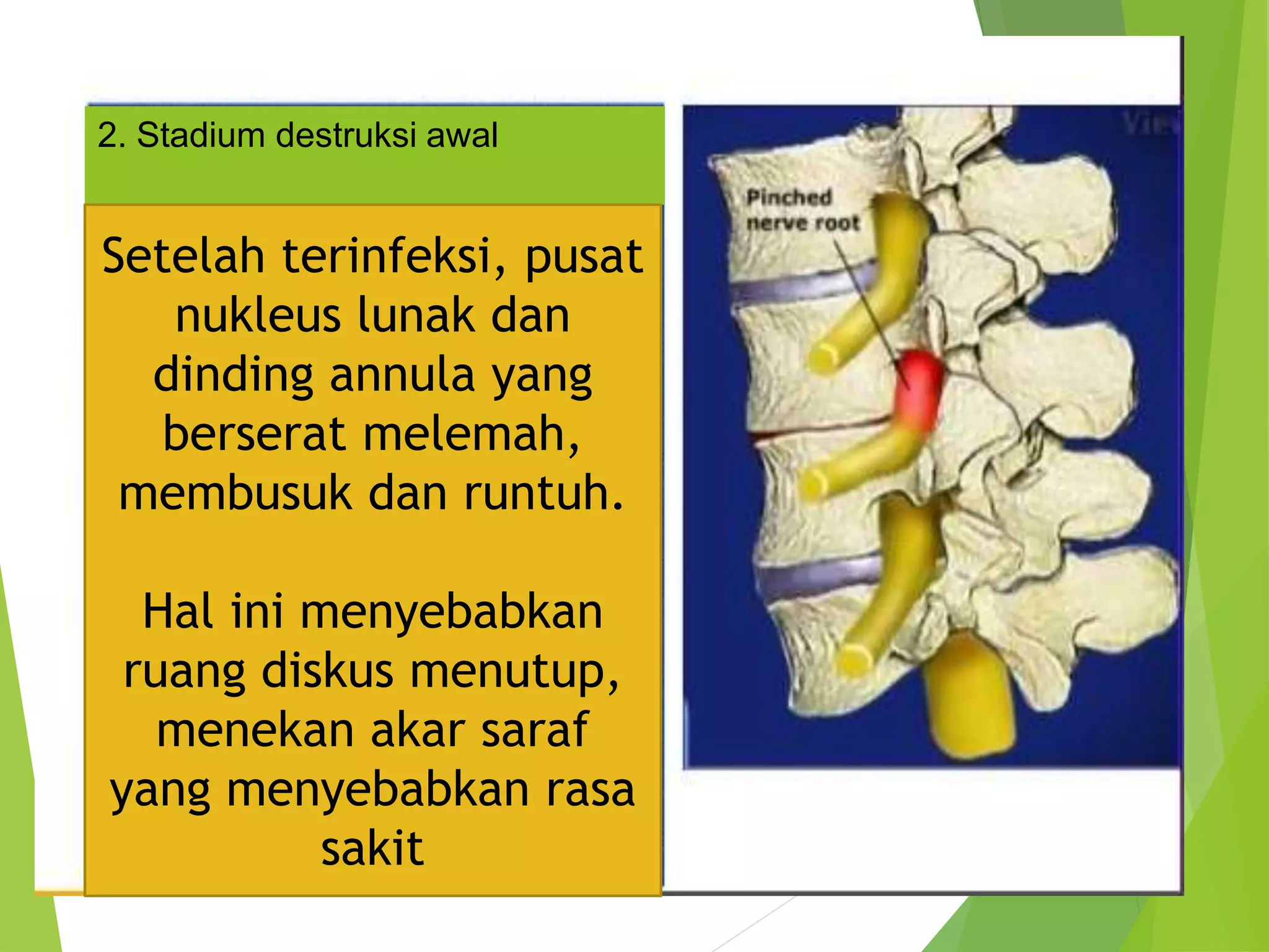 PPT_Spondilitis_TB.ppt