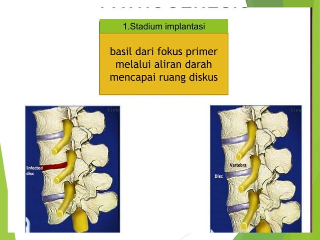 PPT_Spondilitis_TB.ppt