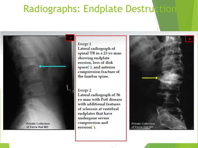 PPT_Spondilitis_TB.ppt