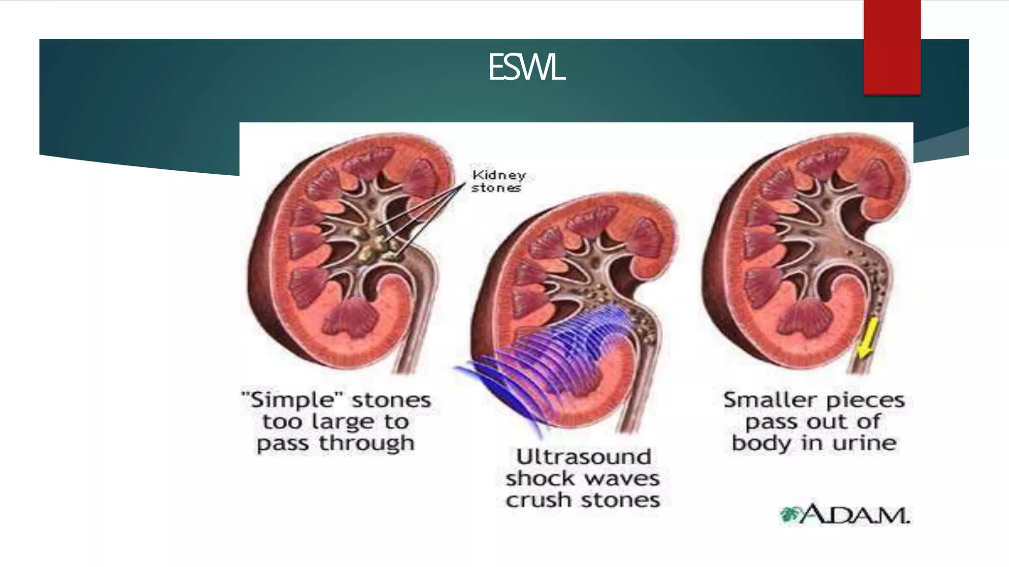 Urinary stone management | PPTX