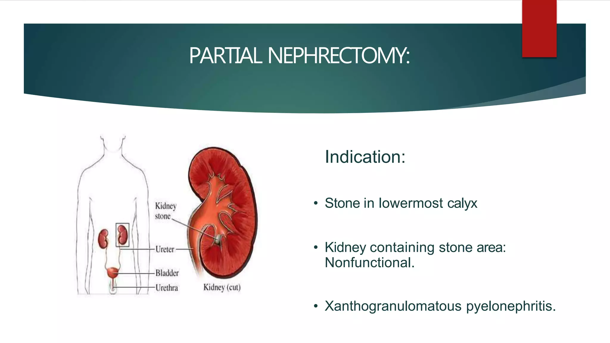 Urinary stone management | PPTX