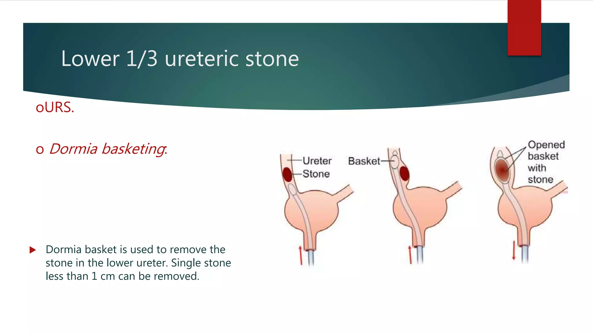 Urinary stone management | PPTX