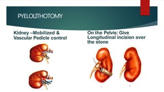 Urinary stone management | PPTX