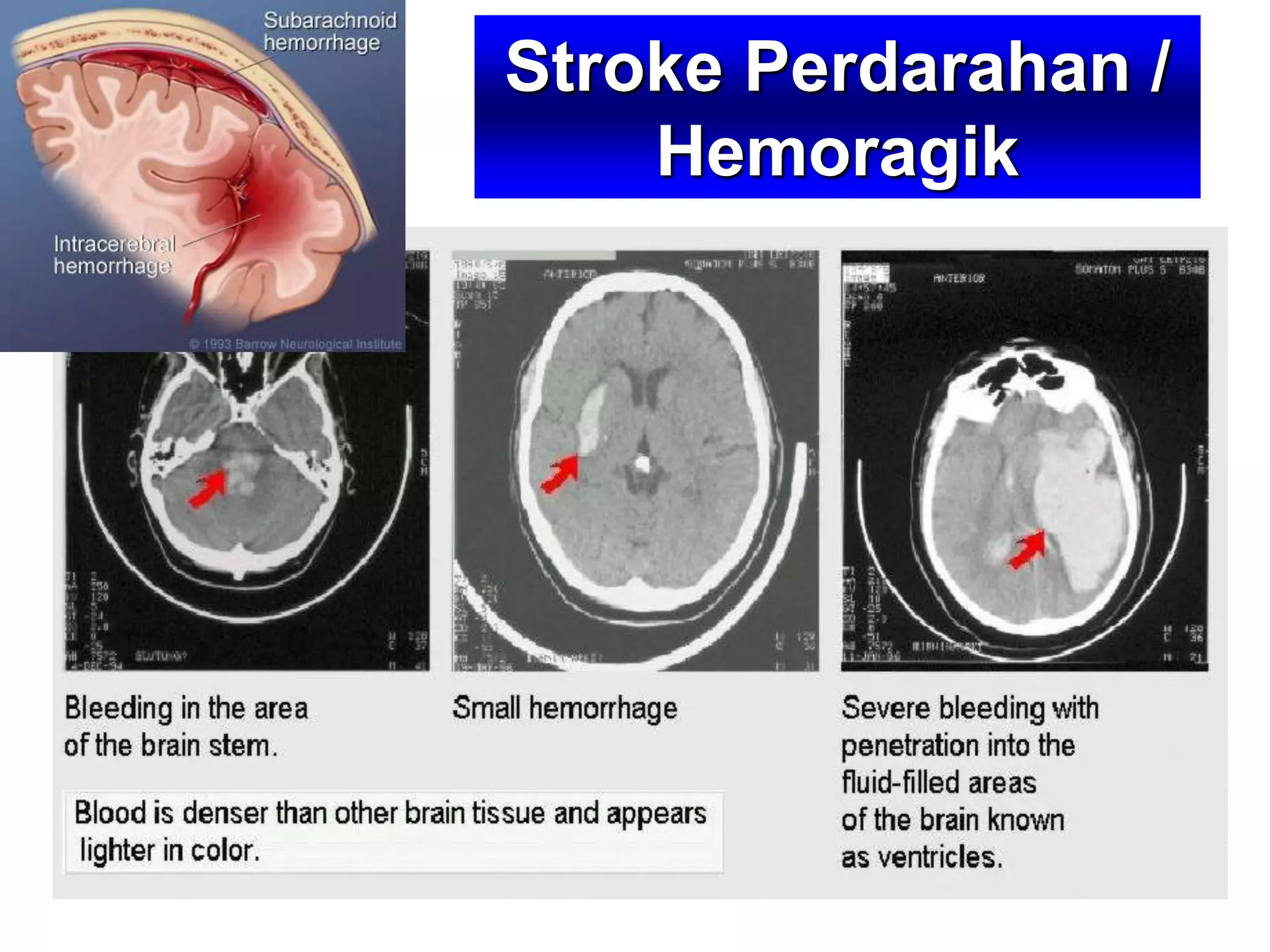 ppt stroke pekerti.pptx