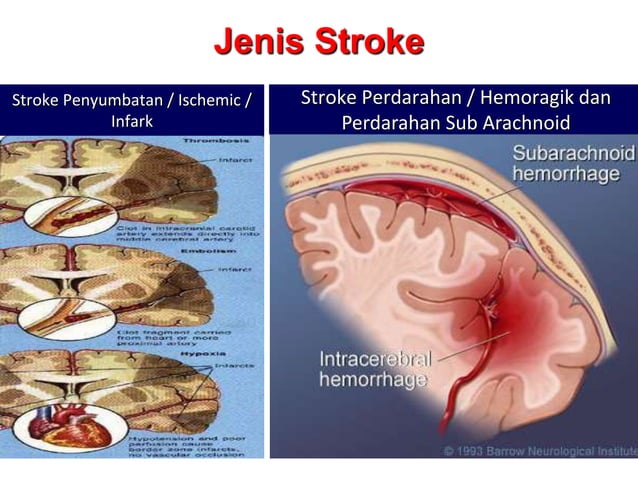ppt stroke pekerti.pptx
