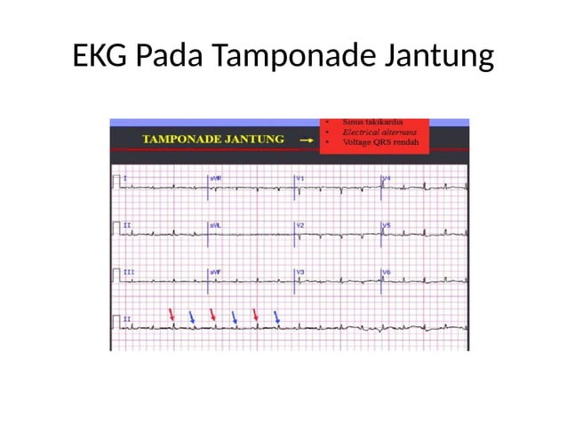 PPT cardiac Tamponade, pada Ny. Y/31thn/ | PPTX
